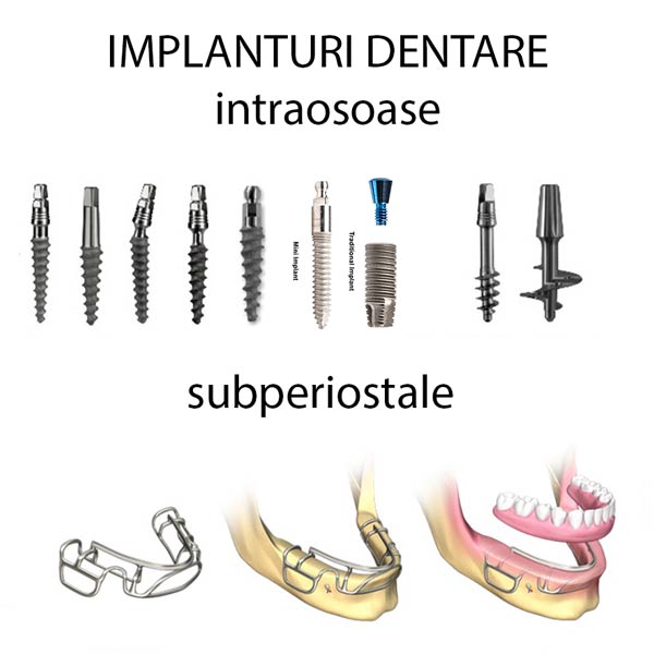 Implant Dentar - Pret & Etape Tratament | Dr. Durbac