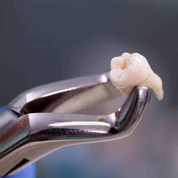 Fatete dentare Bucuresti - Dr Durbac