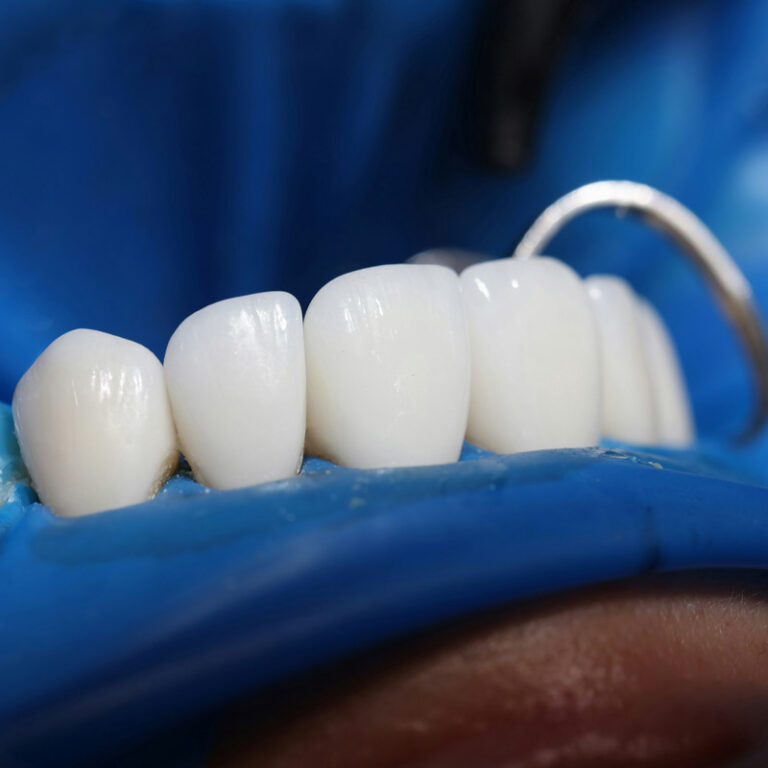 Proteza fixa pe implanturi - Implant all on 4/ all on 6 | Dr. Durbac